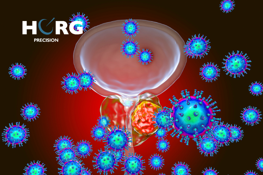 Séquelles après radiothérapie prostate: les troubles urinaires